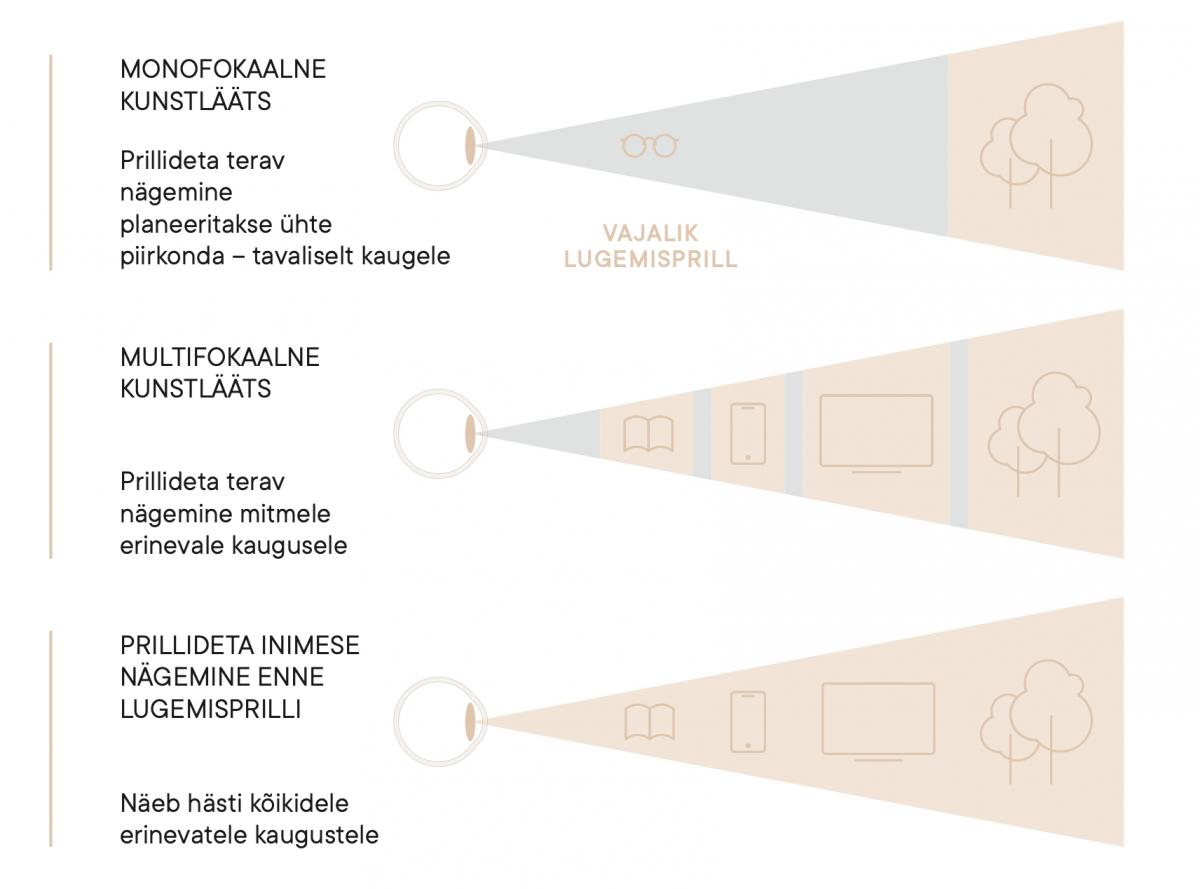 Läätseoperatsioonide liigid | Silmalaser